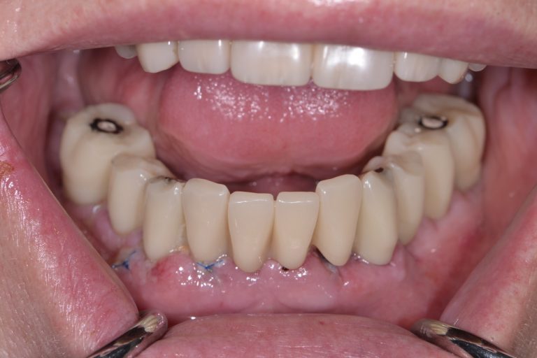 Prothetik bei Patient mit CREST-Syndrom - Der besondere Fall